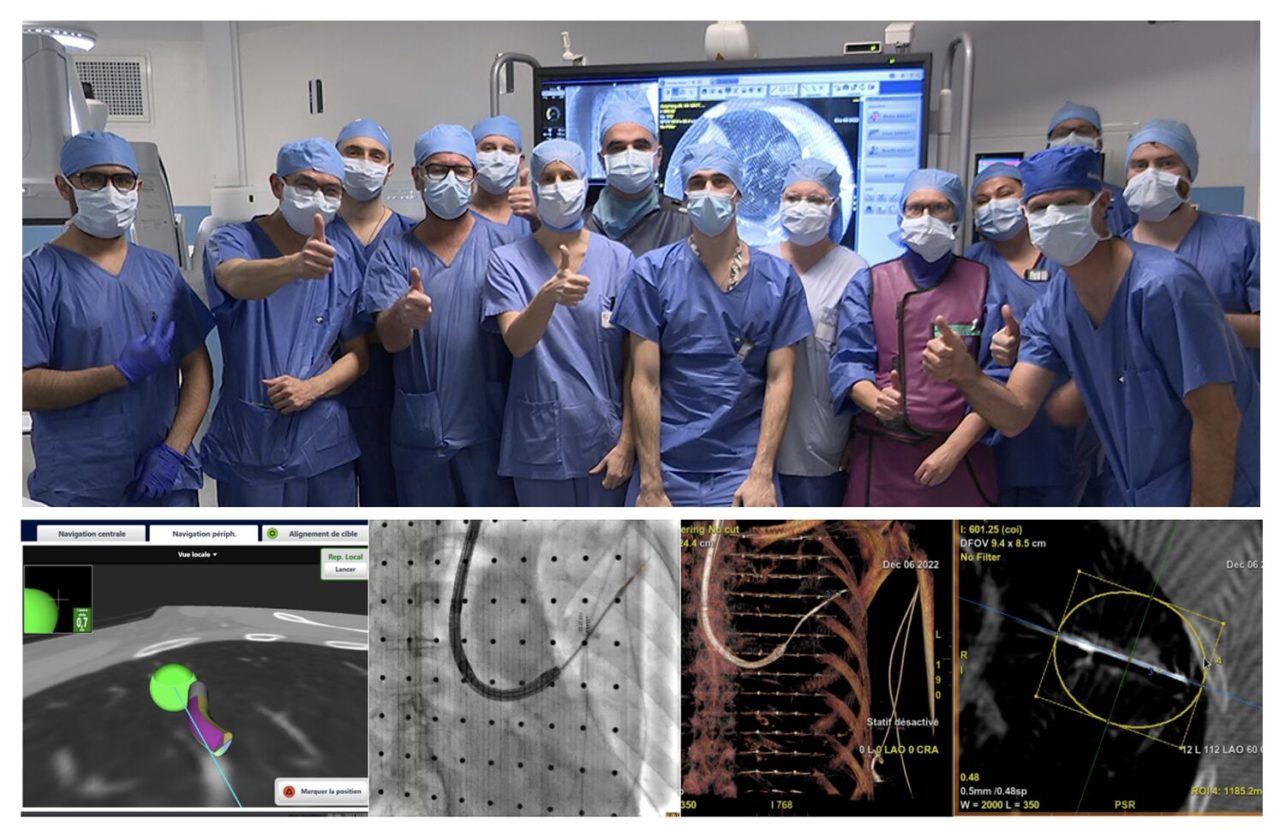 Une nouvelle technique de thermoablation par voie endobronchique ...